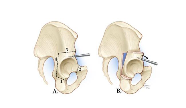 Periacetabular Osteotomy (PAO) – Michael K Ryan, MD